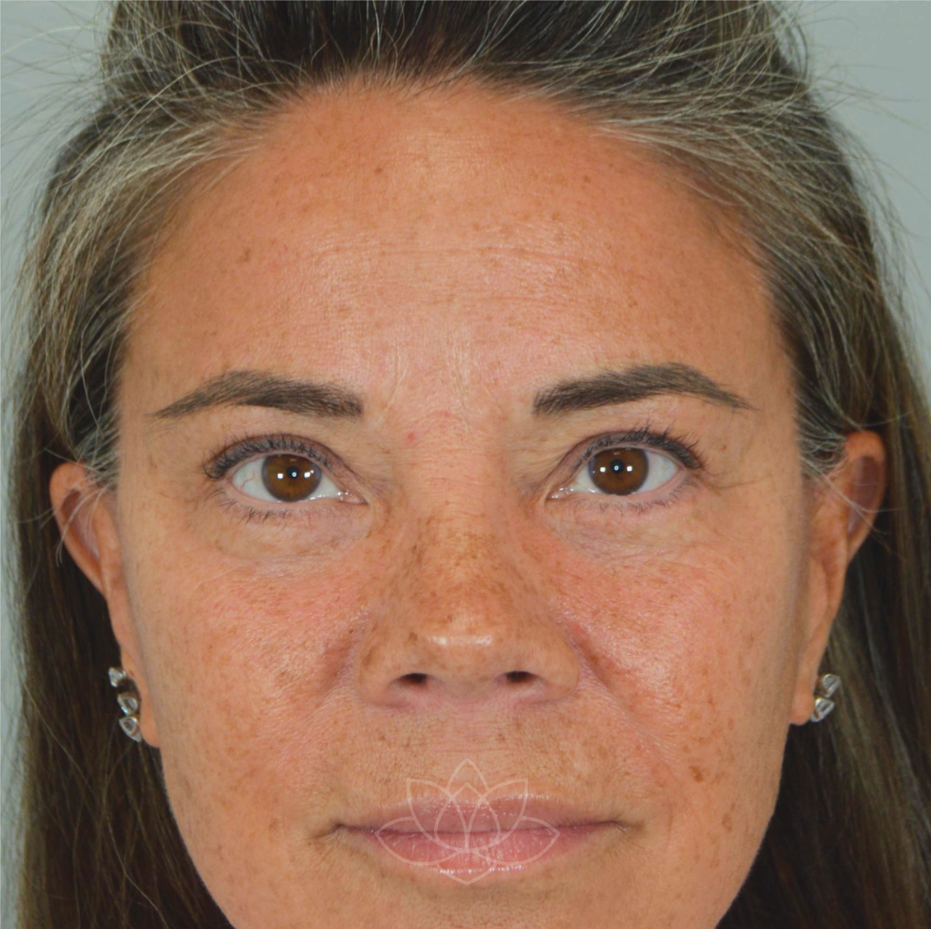 Eyelid Surgery - Wallin