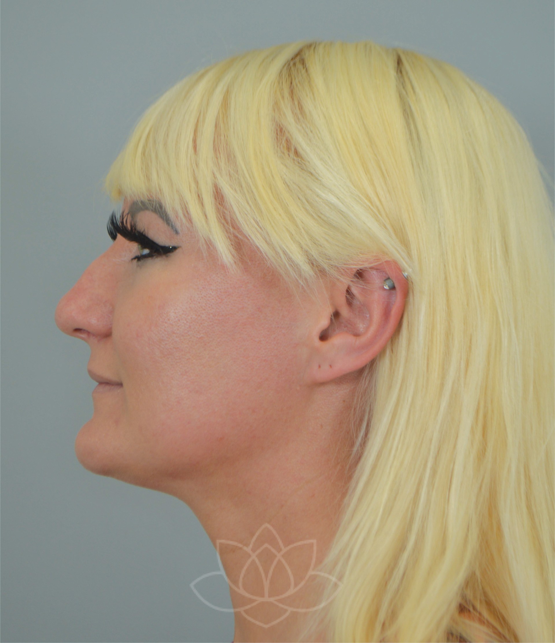 Liposuction - Wallin